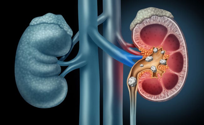 Kidney: Watch Out For These Warning Signs For Chronic Kidney Disease In ...