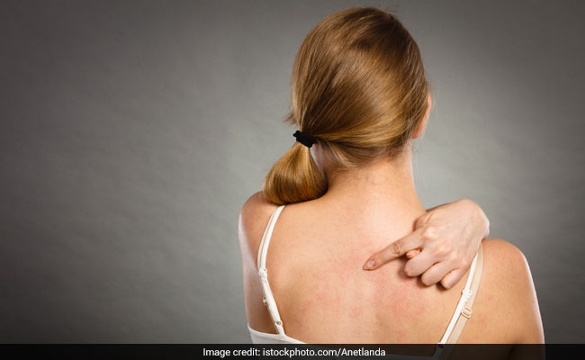 Small Bumps On Your Back Making You Scratch? Here's What You Can Do