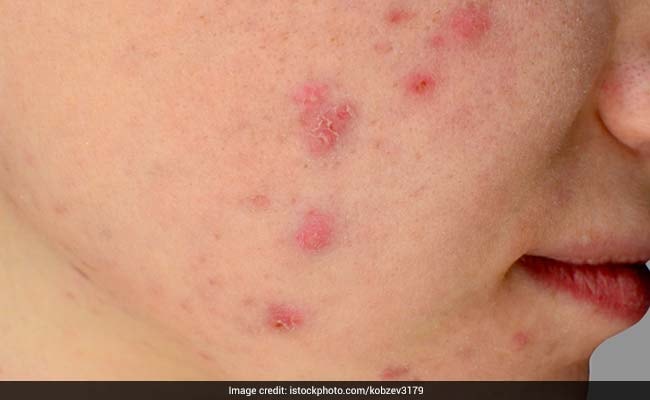 Acne: Types, Causes And Simple Home Remedies That Always Work