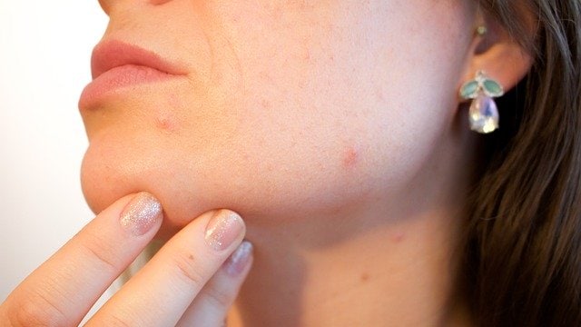 Sweating Under The Face Mask Can Cause Acne- Our Expert Shares Tips To ...