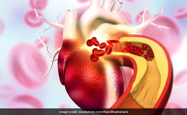High Cholesterol Levels And Heart Disease Risk: Expert Decodes The Link