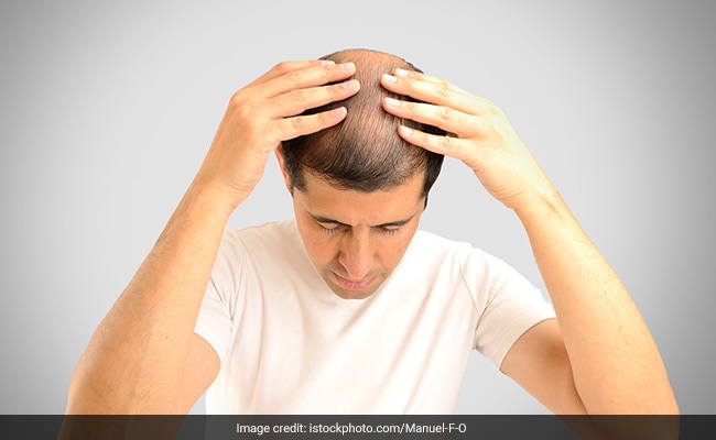Hair Care: 4 Common Types Of Hair Loss And Their Causes
