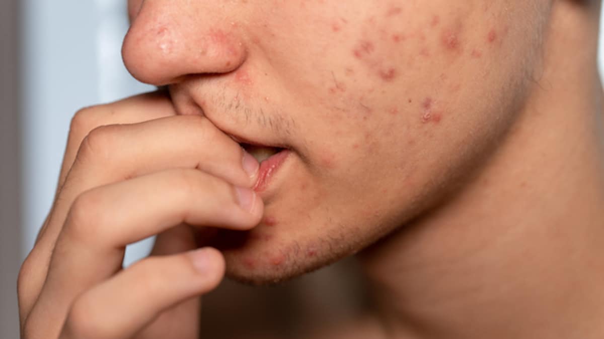 Nail Biting Side Effects: सावधान! अगर आपको भी है नाखून चबाने की आदत तो ...