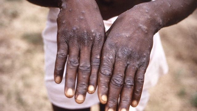 Monkeypox: Should You Be Worried? Here's What Experts Say
