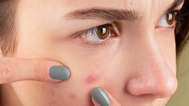 Skincare Tips: Here Are The Most Common Myths About Acne & Diet