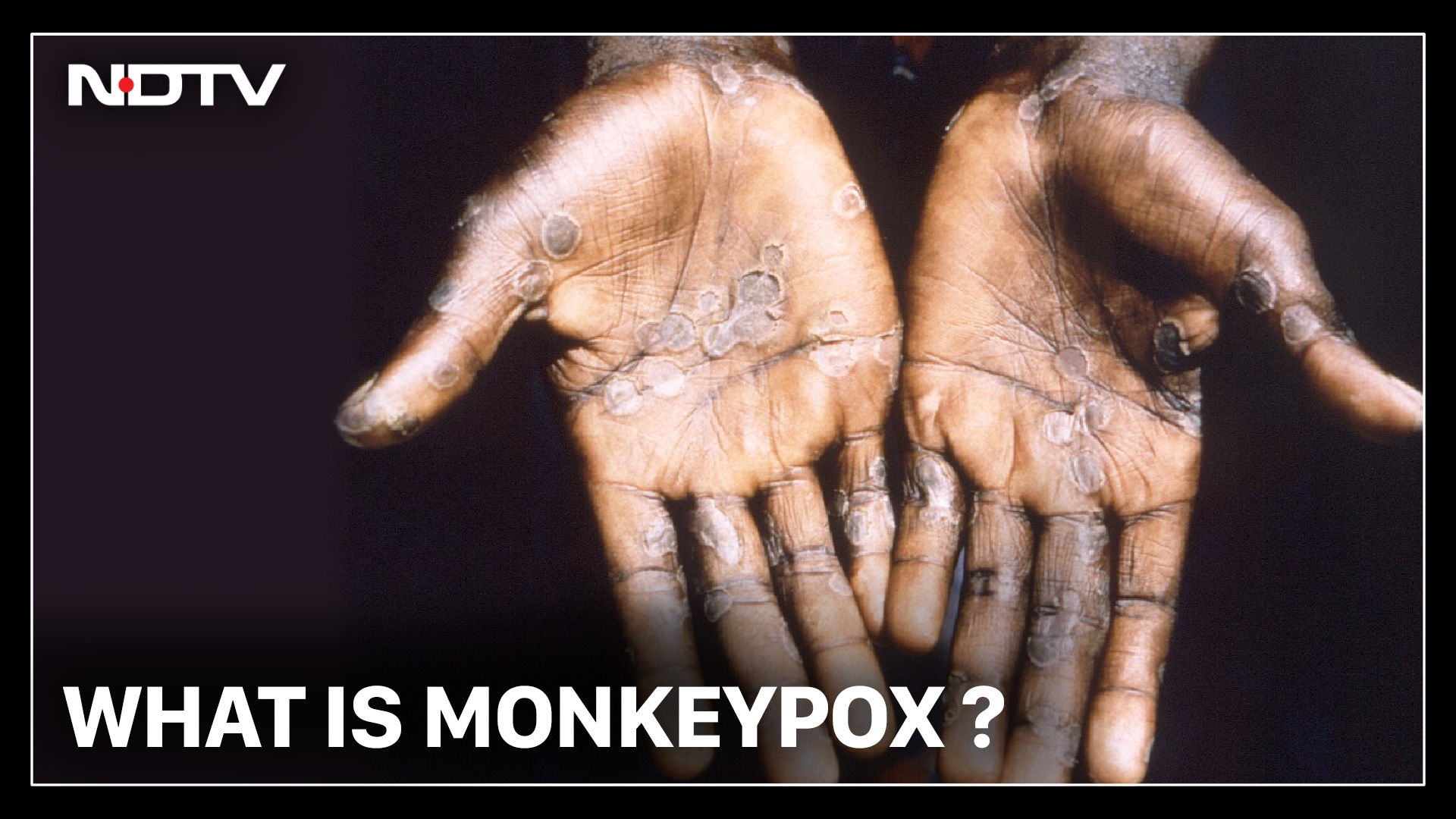 What Is Monkeypox? - 'Hot Mic' With Nidhi Razdan