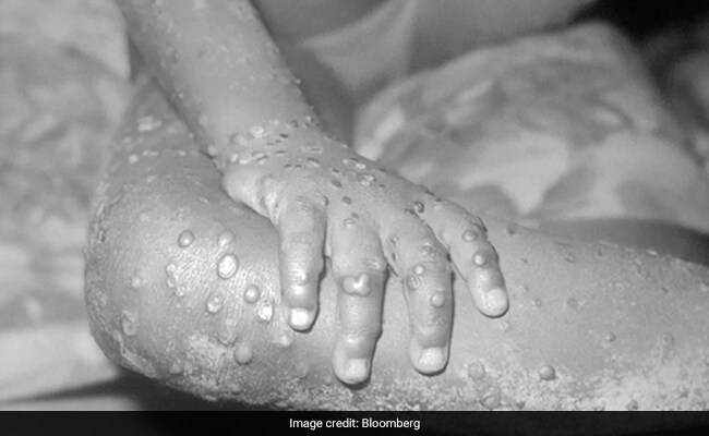 Monkeypox: All That We Know So Far