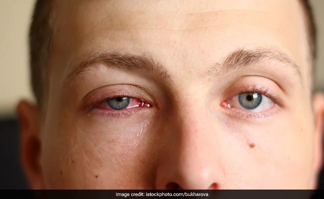Conjunctivitis: 5 Home Care Remedies To Relieve Symptoms For This Eye ...
