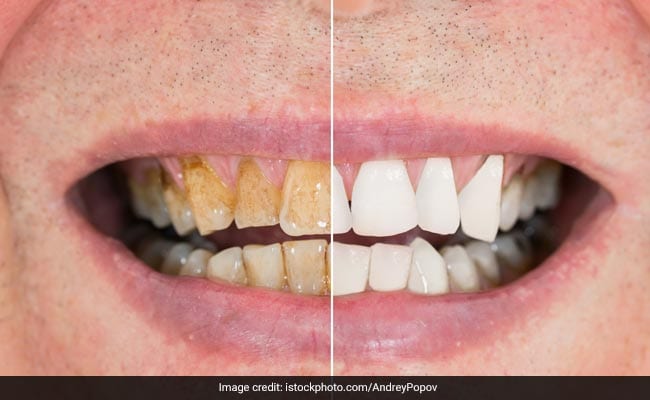 Mustard Oil Mix With Salt For White Teeth Yellow Teeth Home Remedies ...