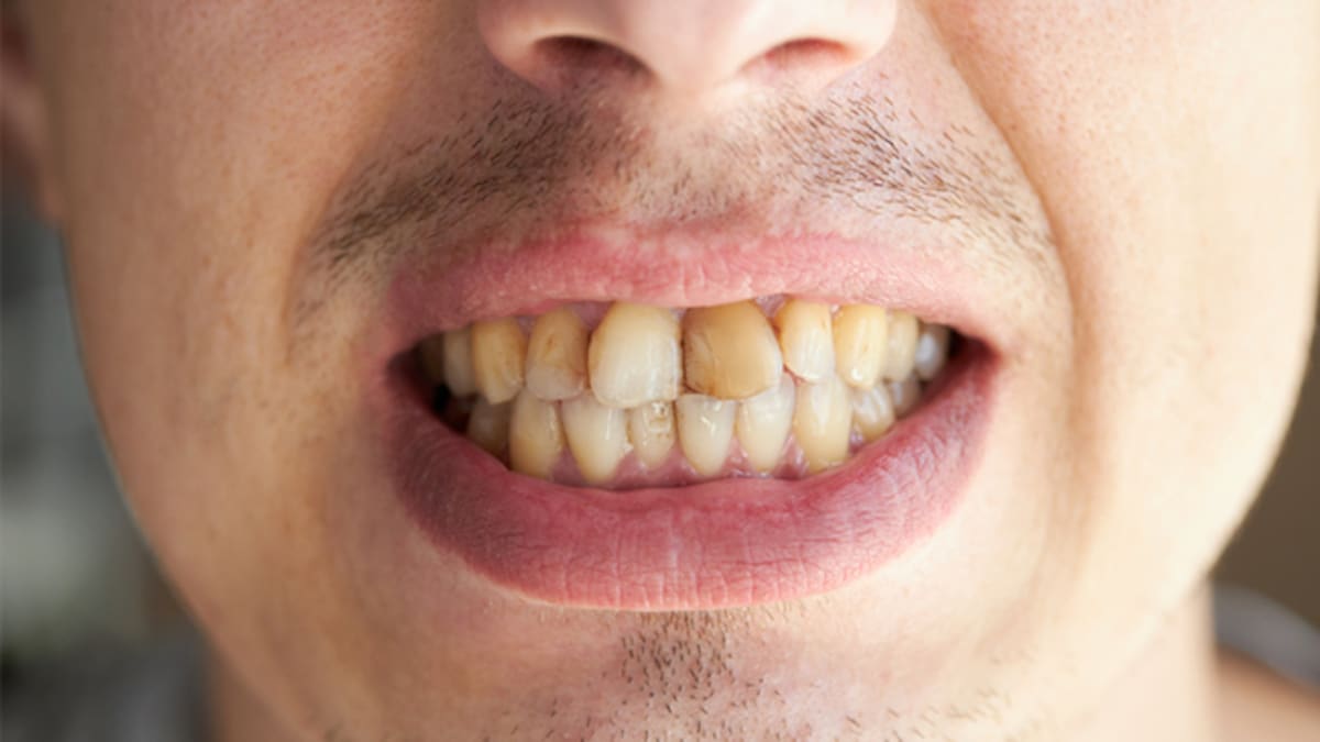 नारियल के तेल में मिलाकर हर रोज दांतो पर लगाएं ये चीज पीले दांत हफ्ते ...