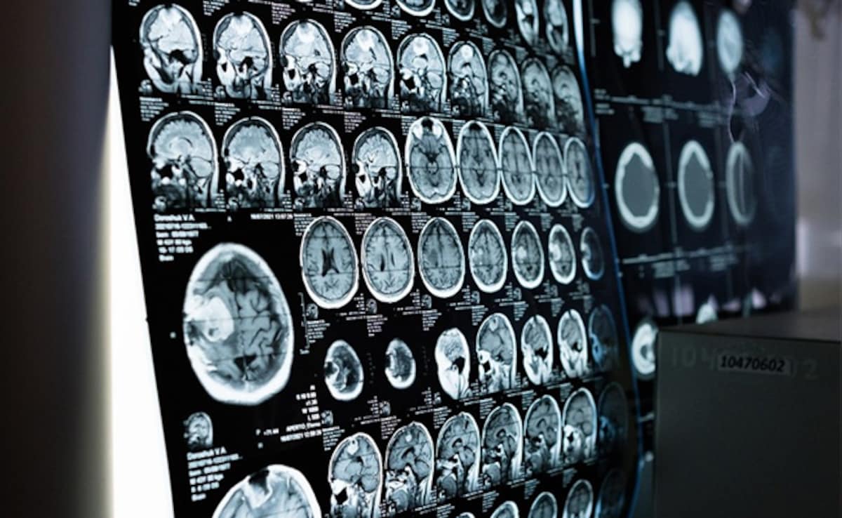 A 5-Minute Brain Scan Can Reveal Risk Of Psychosis In Patients: Study