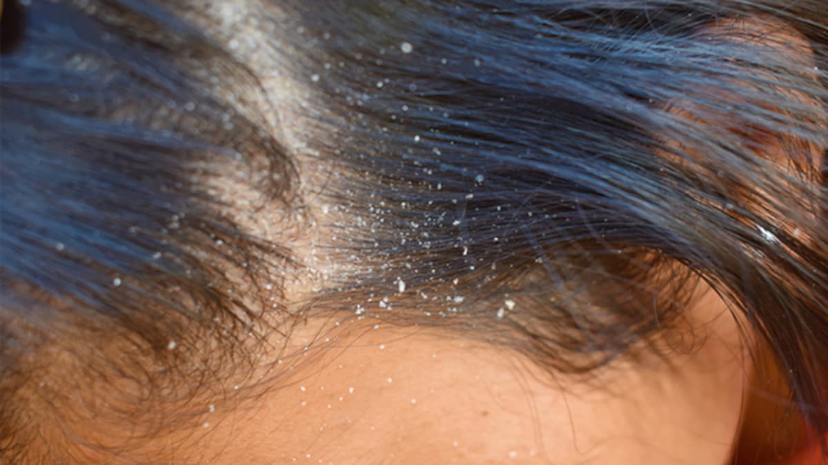 डैंड्रफ से भर गई है खोपड़ी तो 3 उपायों को आज ही अपनाएं, कभी नहीं होगा ...