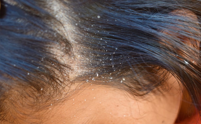 Top 3 Ways To Prevent Dandruff In Winter, According To Expert
