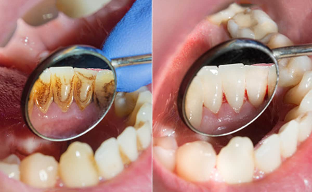 घर पर करें पायरिया का इलाज, यहां जानिए 5 जबरदस्त घरेलू नुस्खे ...