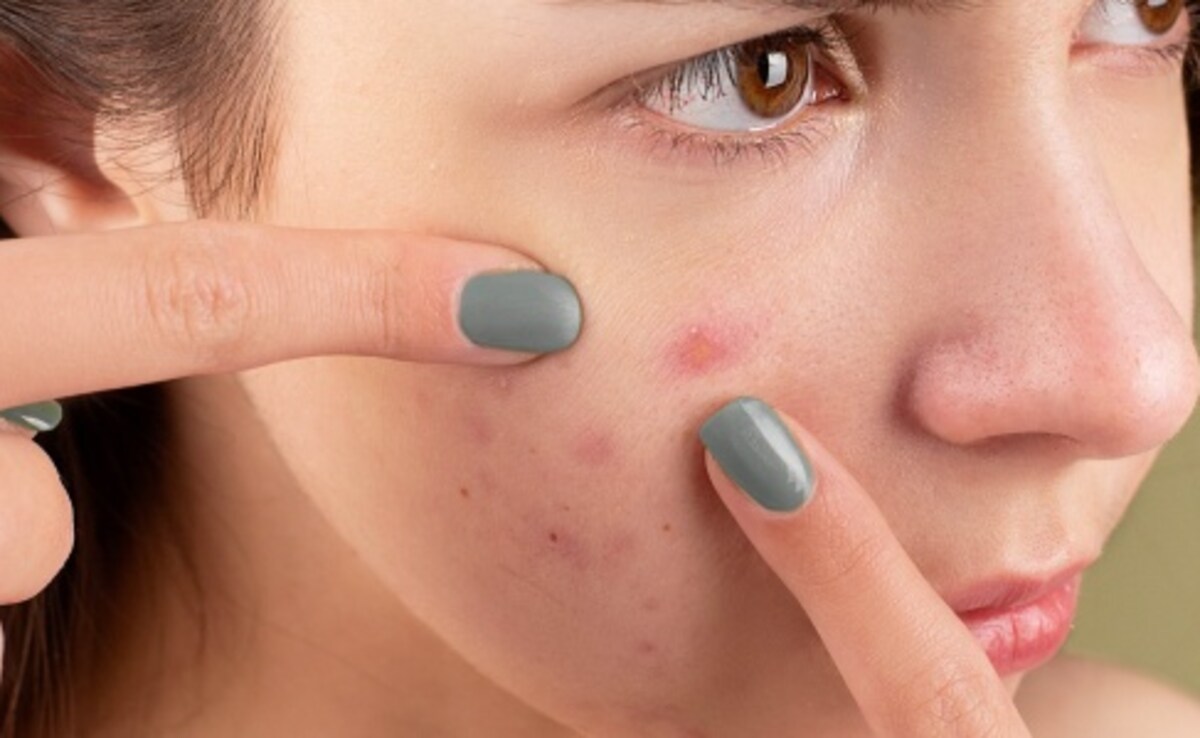 Dermatologist Shares 5 Game Changing Acne-Fighting Hacks