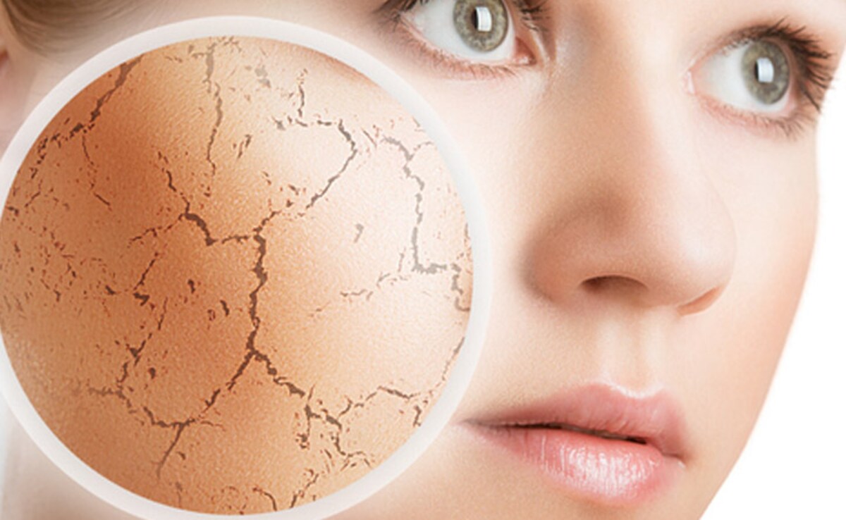 As You Age, Dry Skin Gets Worse In Winter; Desi Hacks That Help