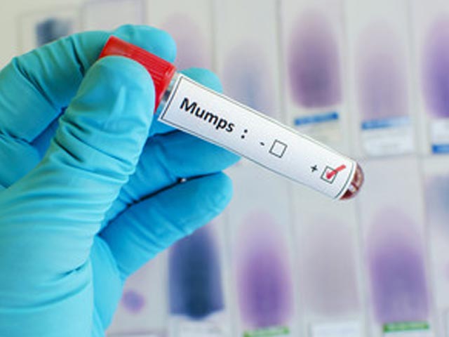 Mumps Outbreak In Delhi, Other States? What Doctors Say