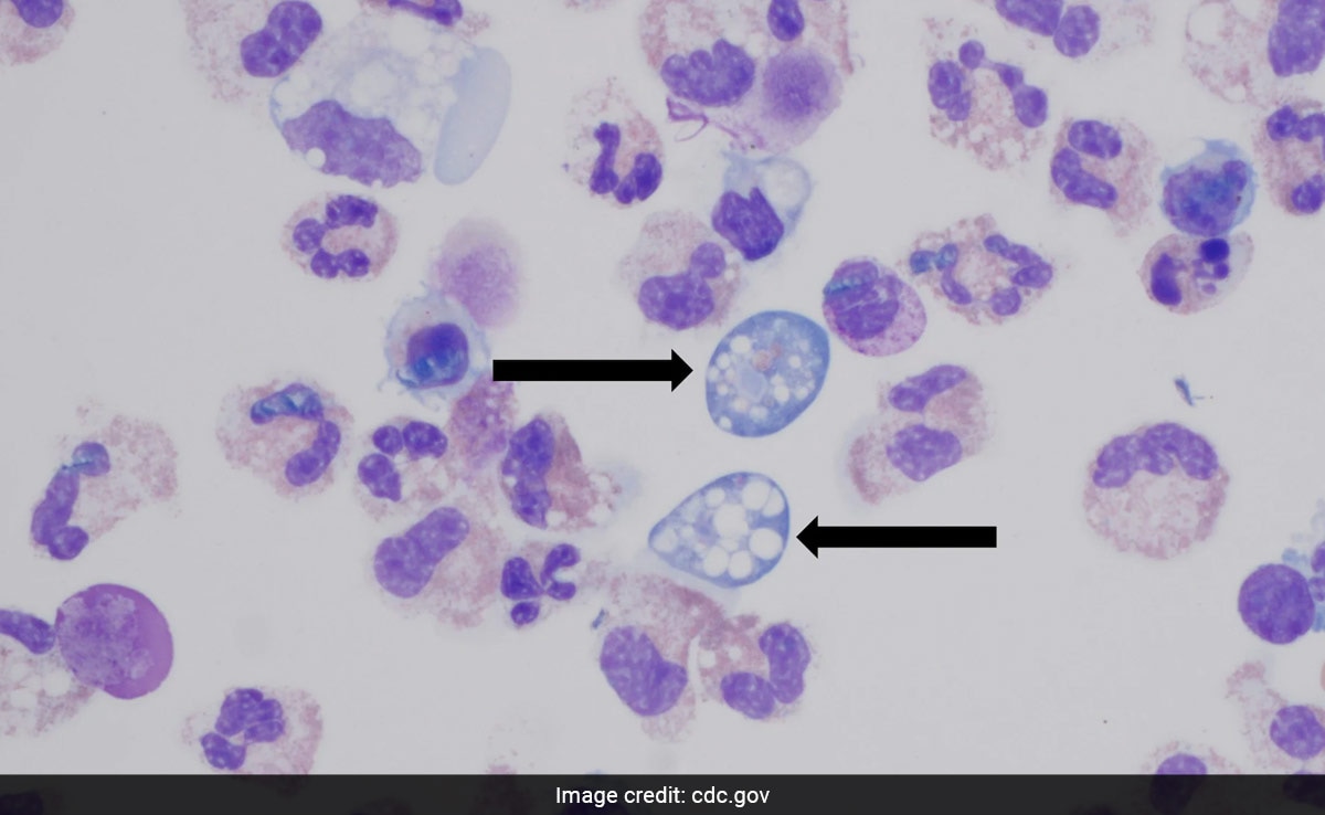 Surge In Deadly Brain-Eating Amoeba Cases In Kerala: Why And How It Spreads