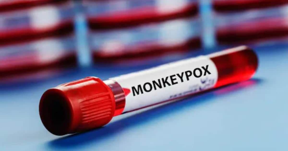 Monkeypox: Early Signs And Symptoms