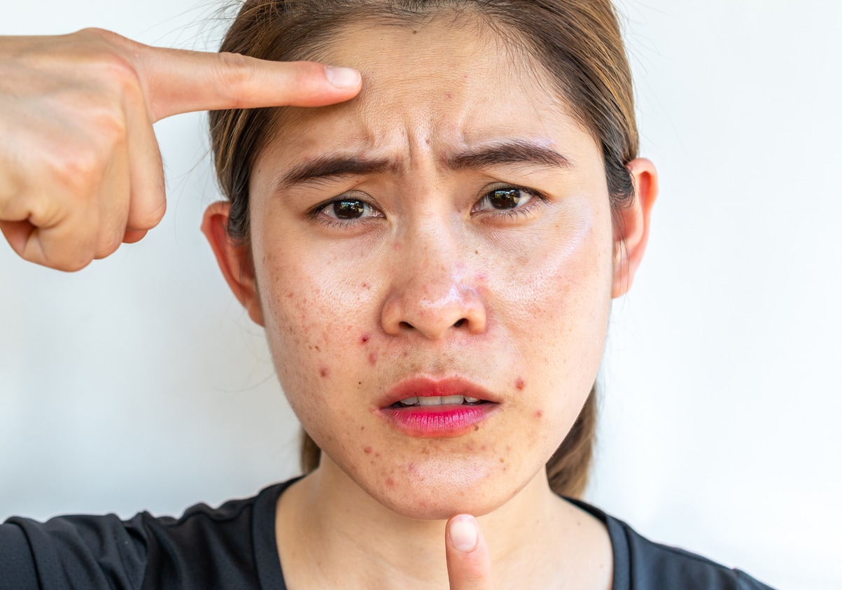 Psoriasis VS. Eczema: Understanding The Differences And Natural Treatments