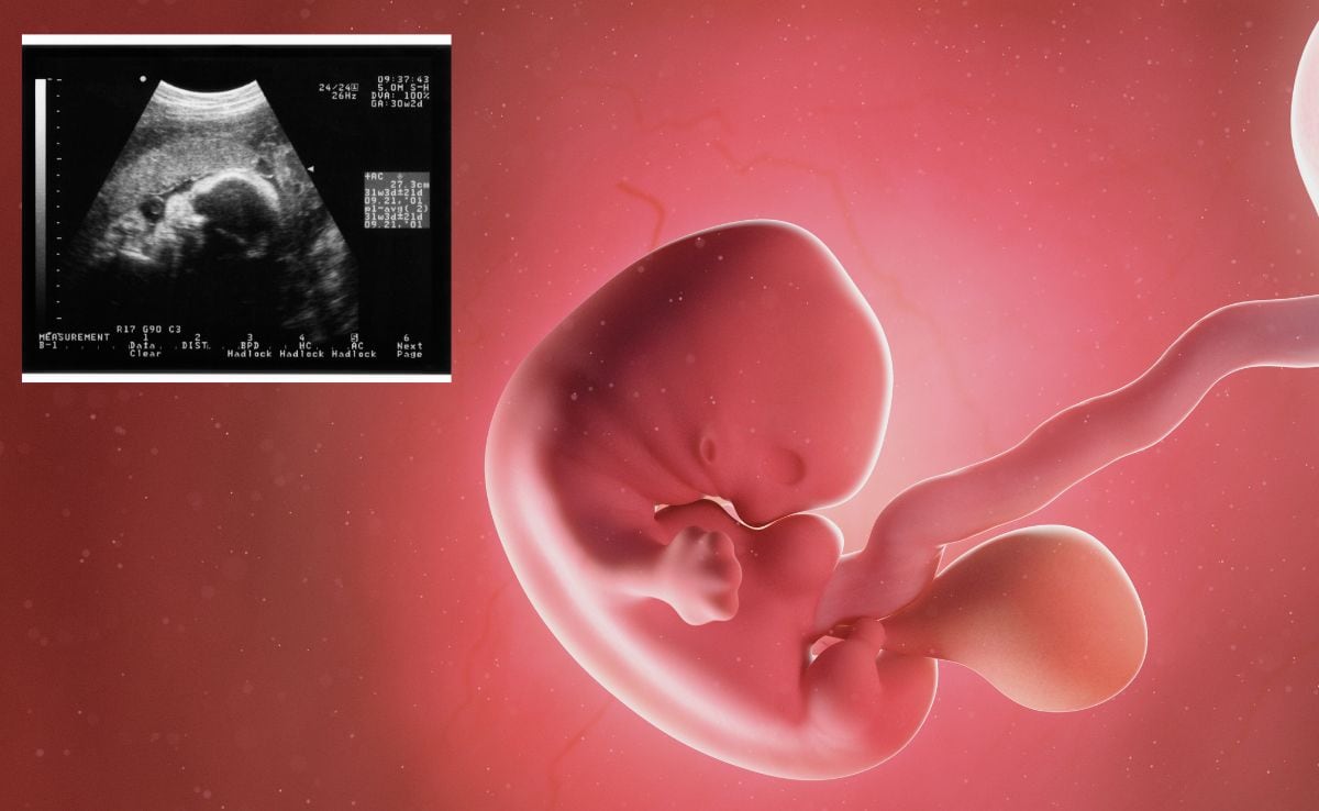 Fetus in Fetu 4 day old girl baby pregnant in madhya pradesh doctor ...