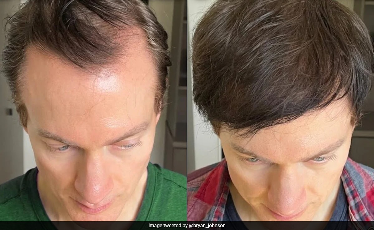 Tech Millionaire Bryan Johnson Reveals How He Reversed His Hair Loss ...
