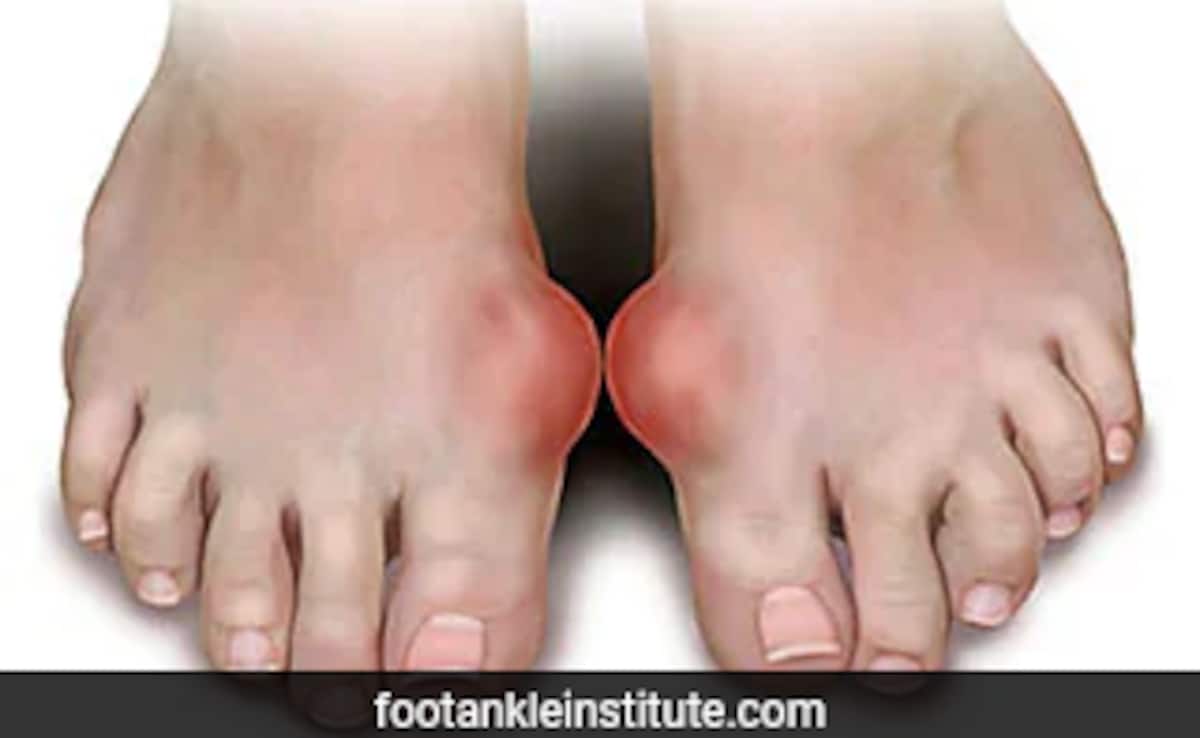 Gout Study Reveals Surprising Factor Behind Gout - It's Not What You Think