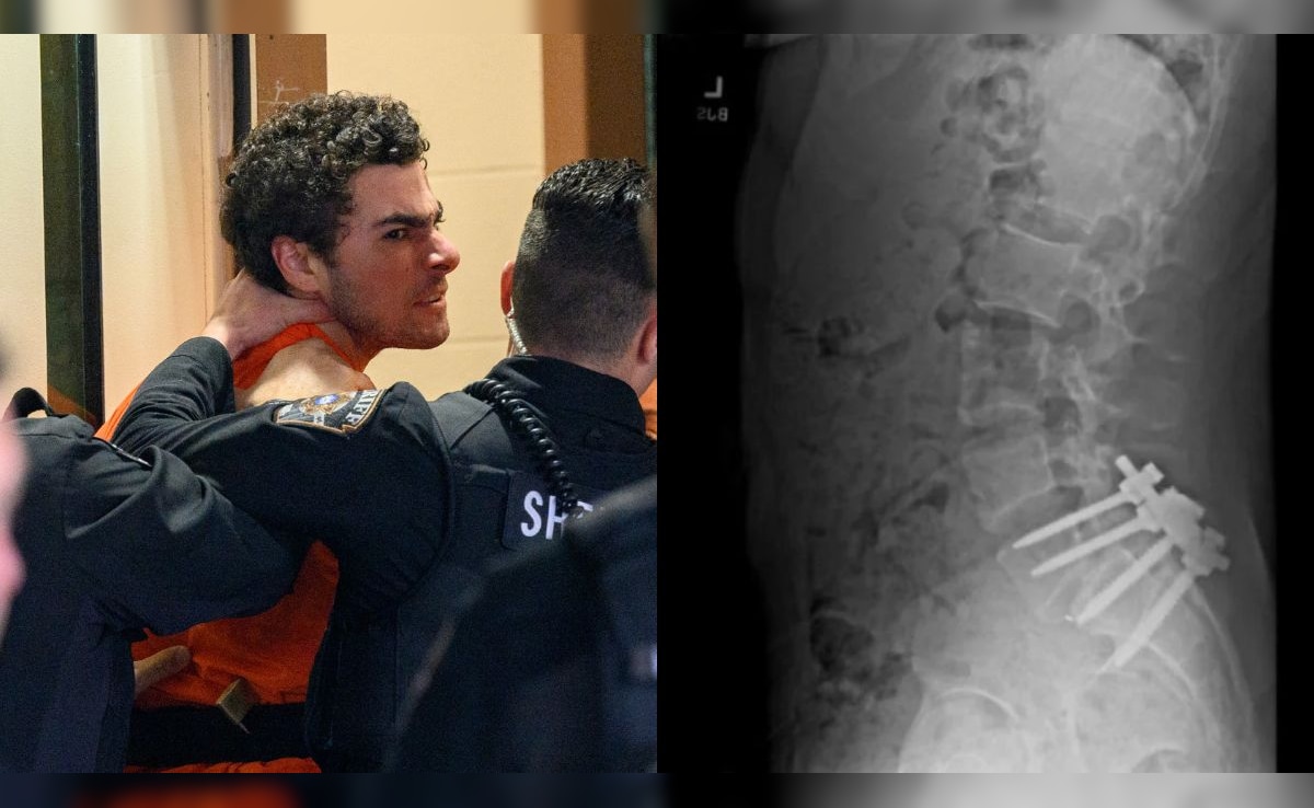 Why Luigi Mangione Killed UnitedHealthcare CEO: A Chronic Back Pain Link