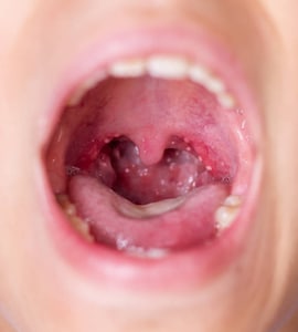 small soft tonsil stones