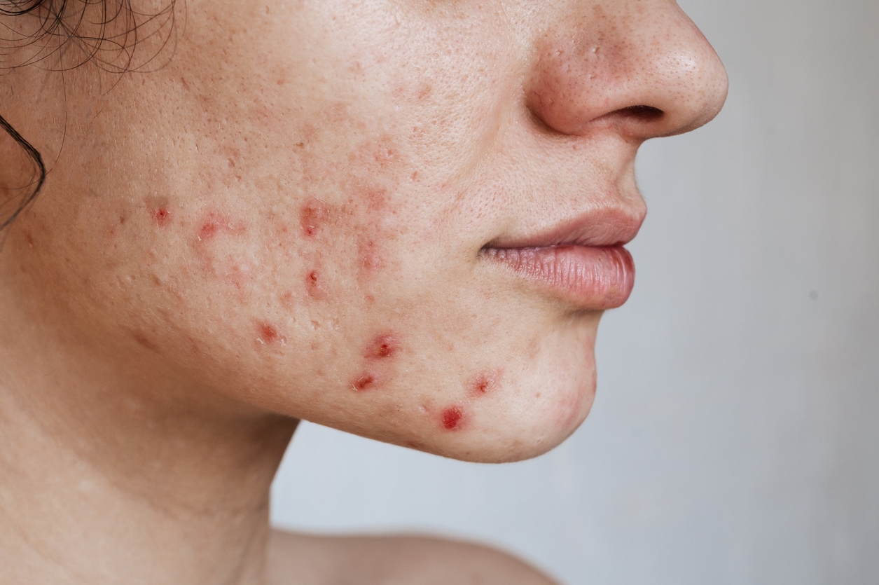 Use These Natural Ingredients For Cystic Acne Treatment