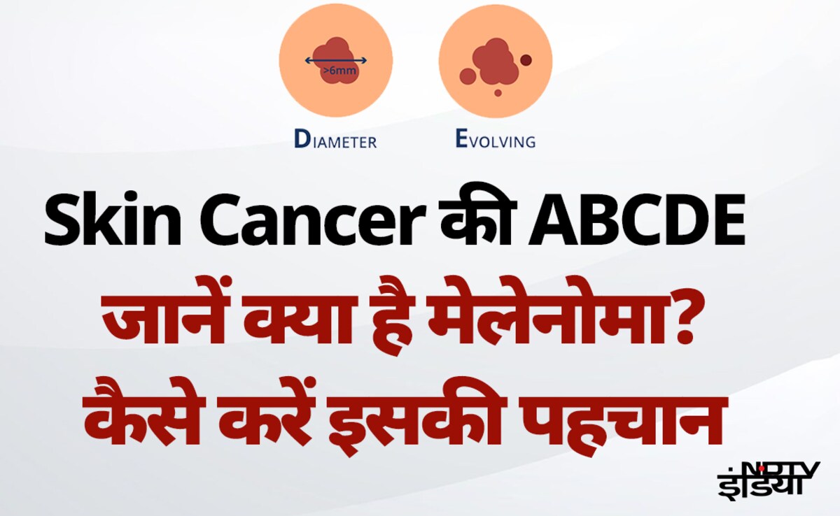 Explainer: क्या होता है काला ट्यूमर या मेलेनोमा, जानें Skin Cancer के ...