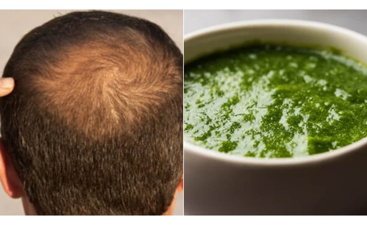 धनिया पत्ती आपके गंजे सिर पर उगा सकता है बाल, यहां जानिए कैसे ...