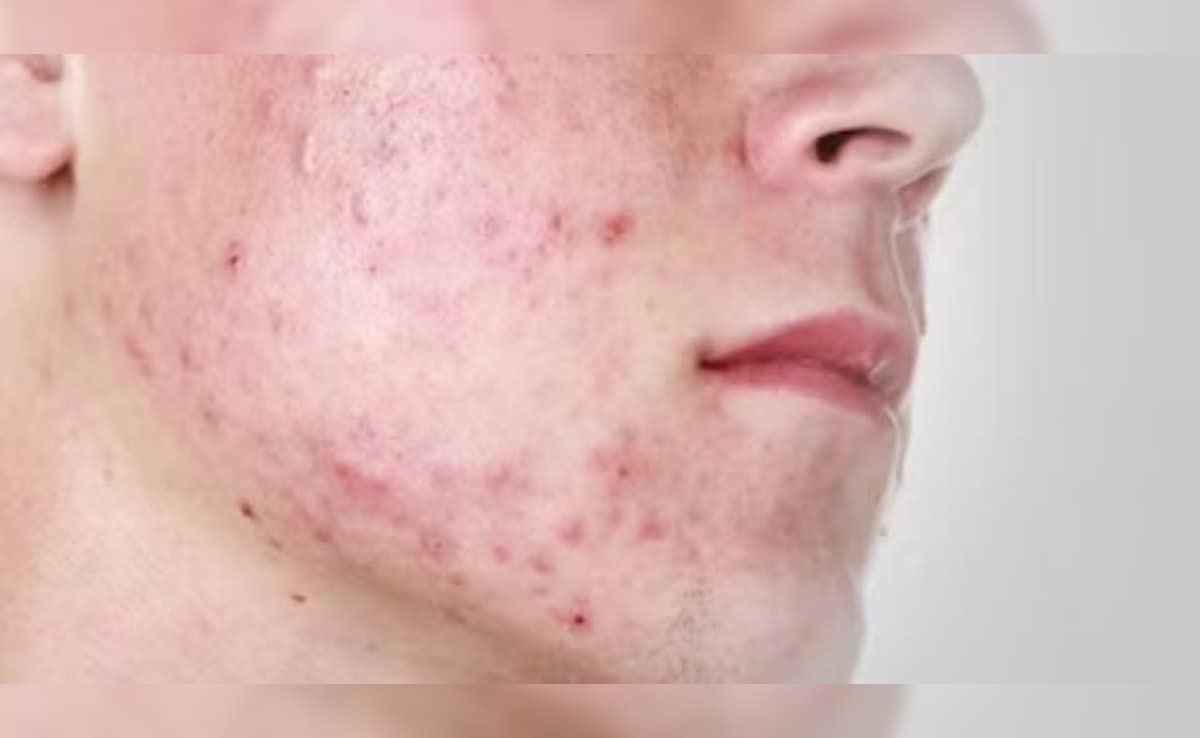 आप भी एक्ने और पिंपल्स के दाग दूर करने के लिए अपनाते हैं घरेलू नुस्खे ...