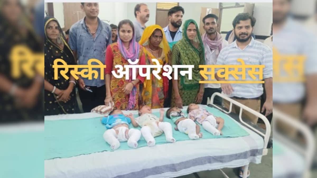 जन्म से पैदा हुए थे टेढ़े पैरों वाले ये चार बच्चे, भगवान बन गए डॉ. रवि; ऐसे... दिया नया जीवन ...