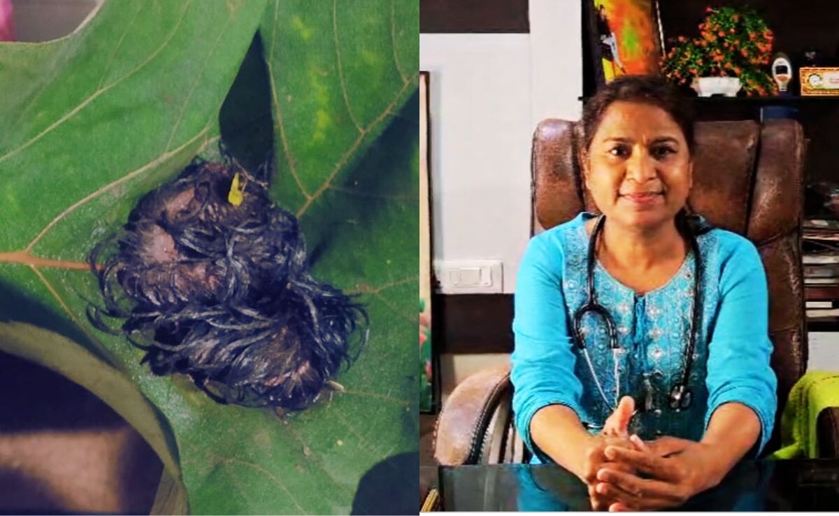 Hairball removed from stomach of 10-year-old girl in Amravati district