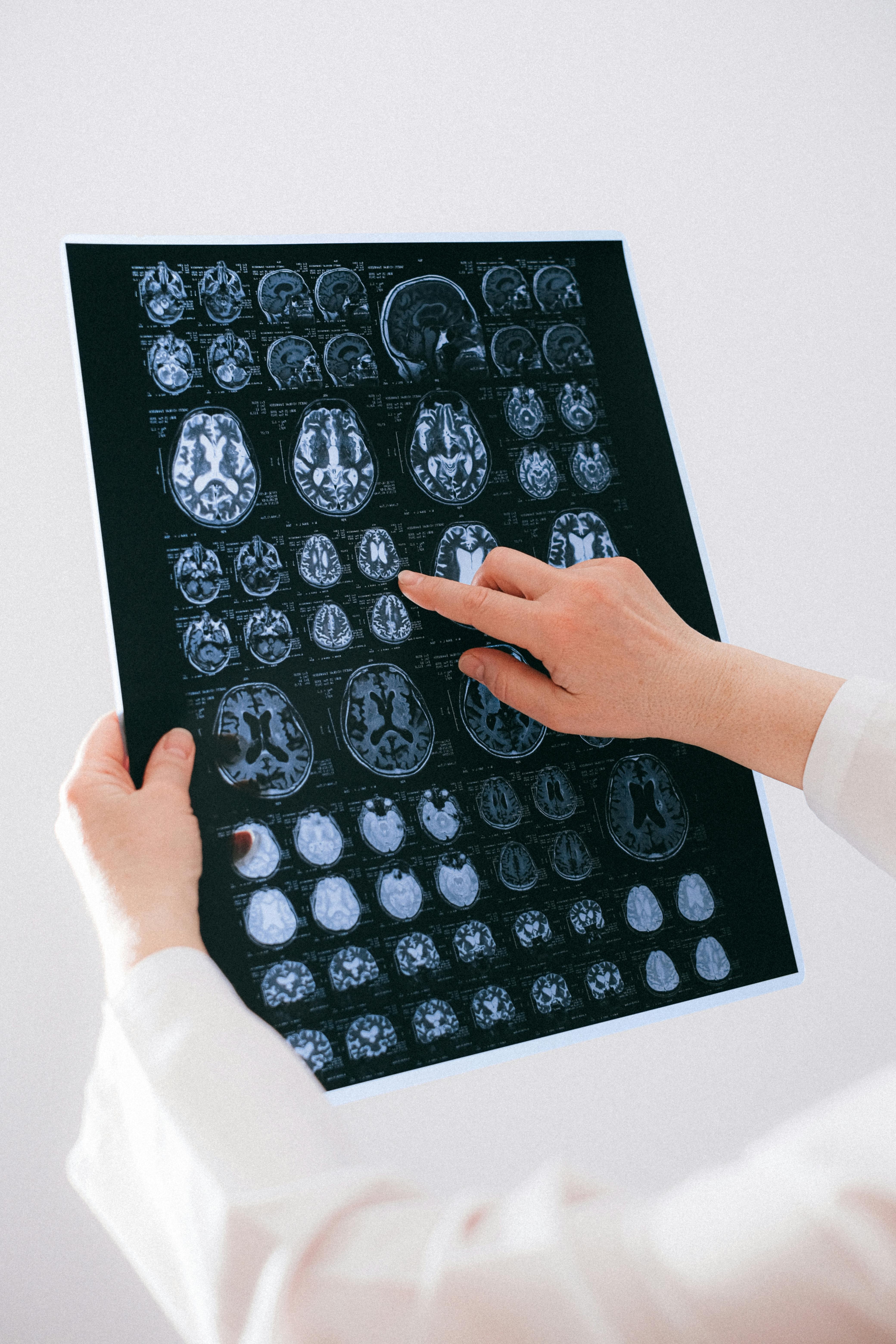 Dementia: Early Signs Beyond Cognitive Decline And Forgetfulness