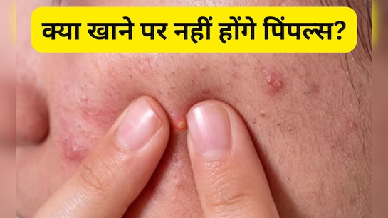 pimples removal on face at home in hindi