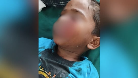 stray dogs attack child
