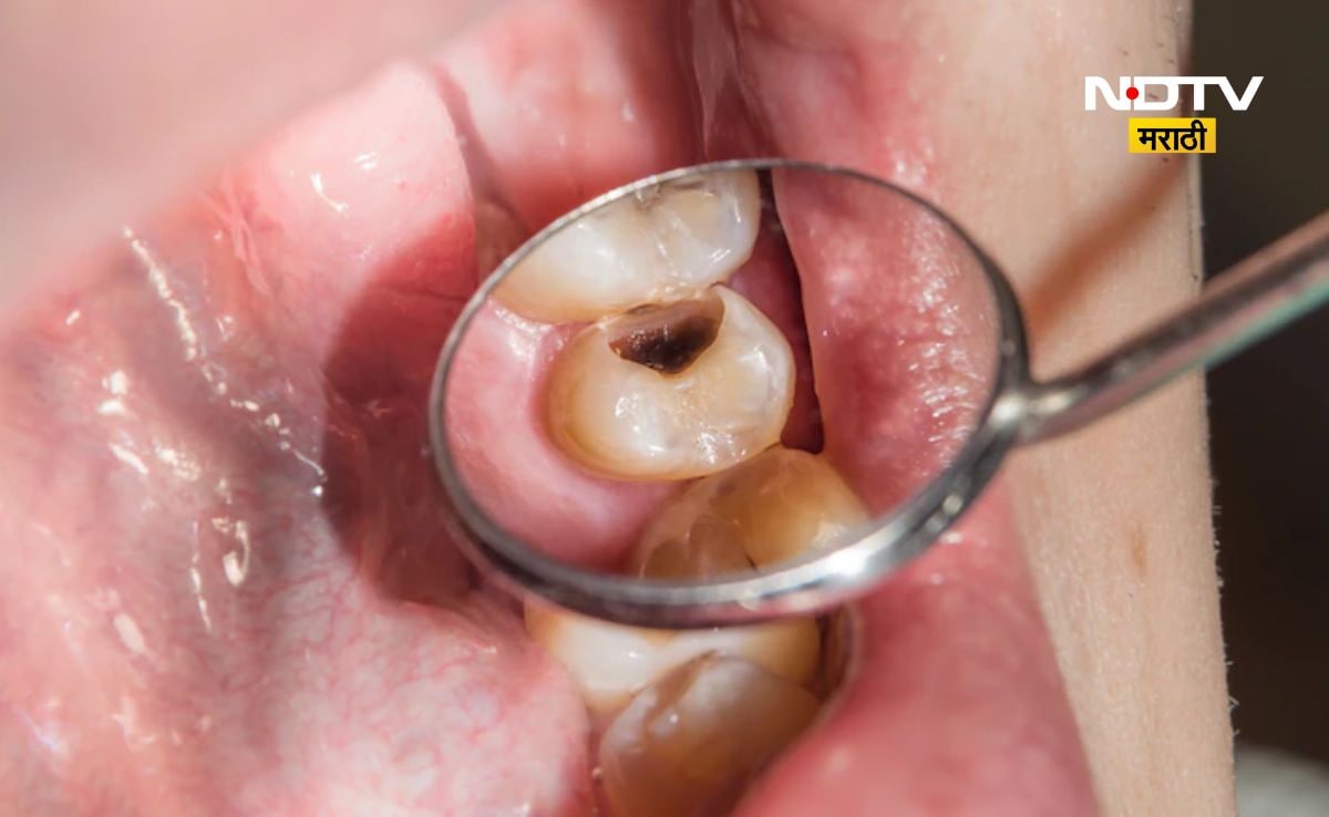 how to remove dental cavity at home with effective remedies