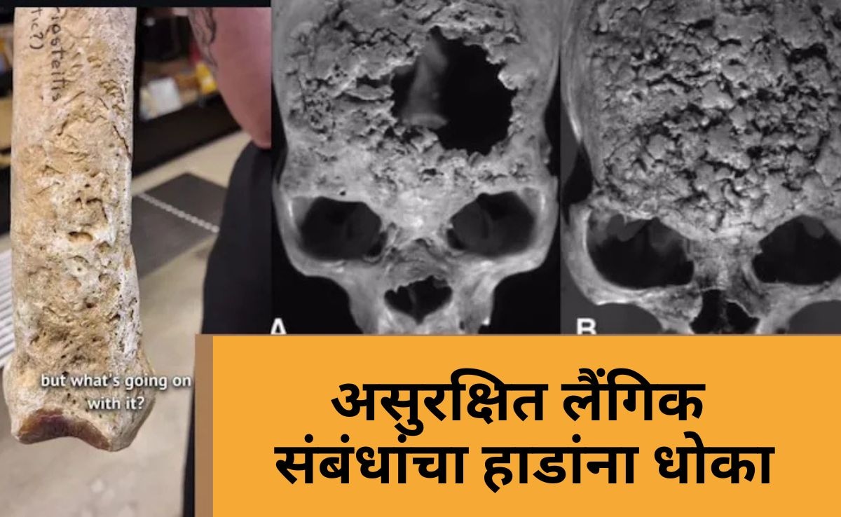 This STD can weaken your bones; Know the symptoms and treatment to ...