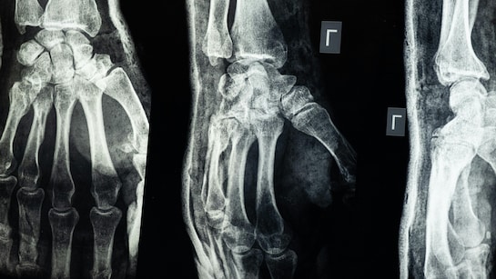 broken bone fusion