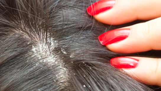 dandruff keeps falling