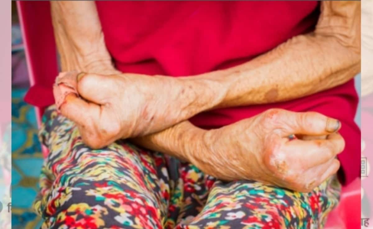 Leprosy-Free India Mission: Government To Ensure Free Screening And ...