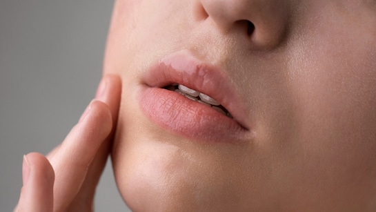 cracked bleeding lips