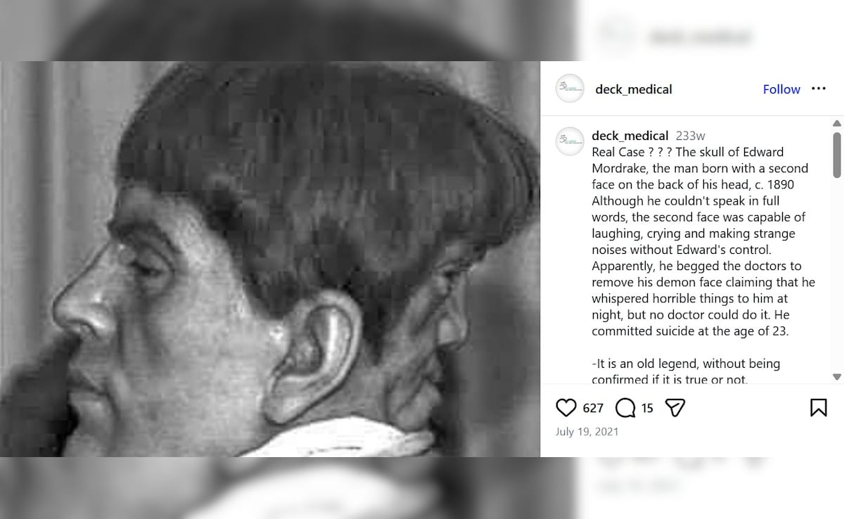 इतिहास का सबसे दुर्लभ केस, एक-दूसरे के दुश्मन बने इंसान के 2 चेहरे ...