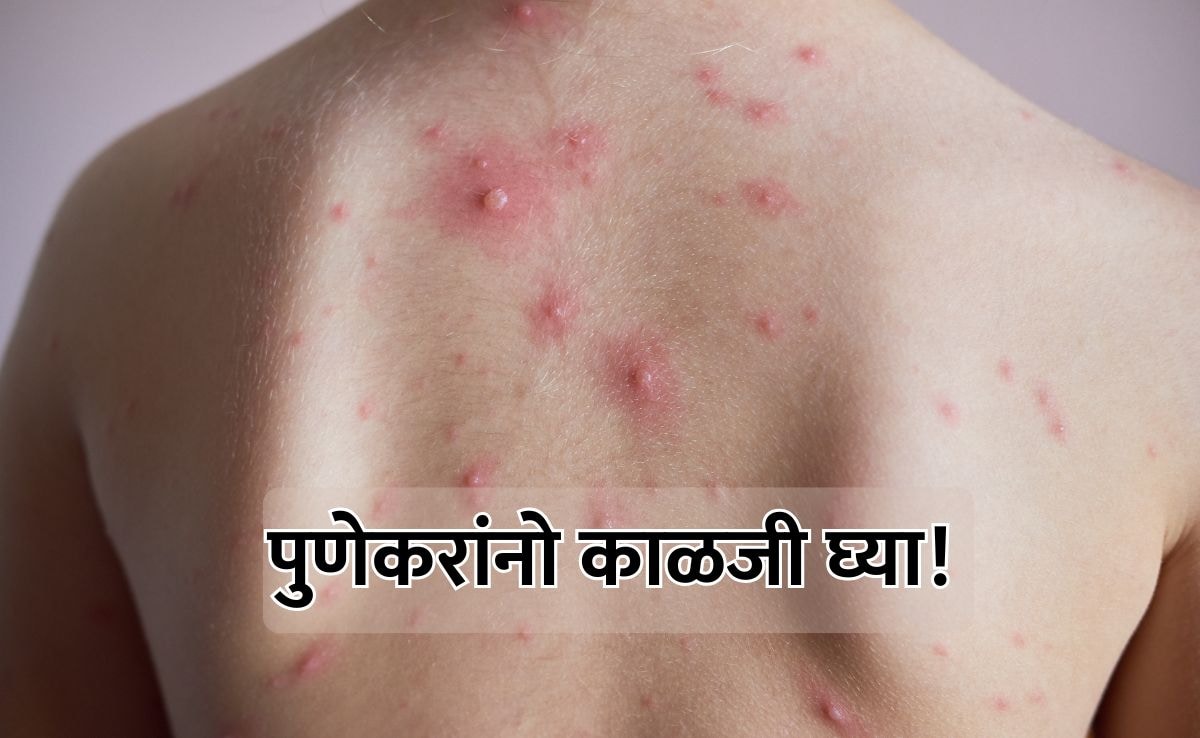 Chickenpox Outbreak in Pune 2026 Cases Rising Among Children and Adults ...