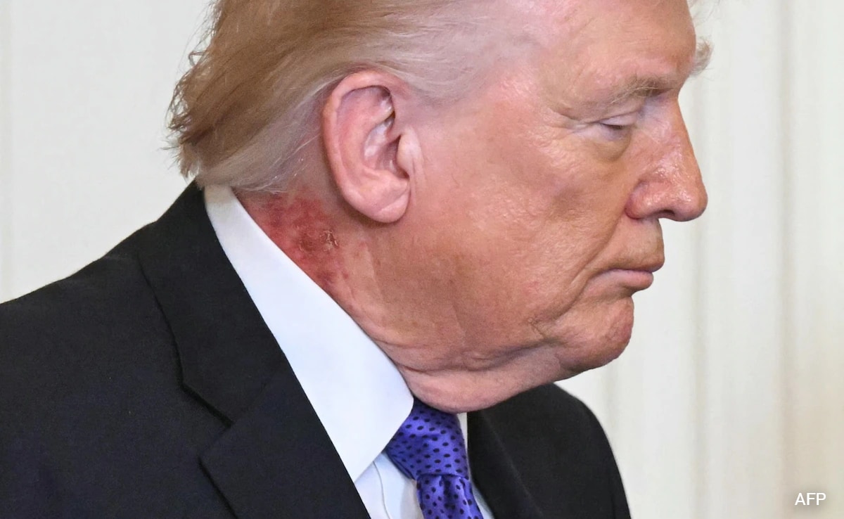 Trump Appears With Red Rash On Neck, Officials Say Caused By Skin Cream