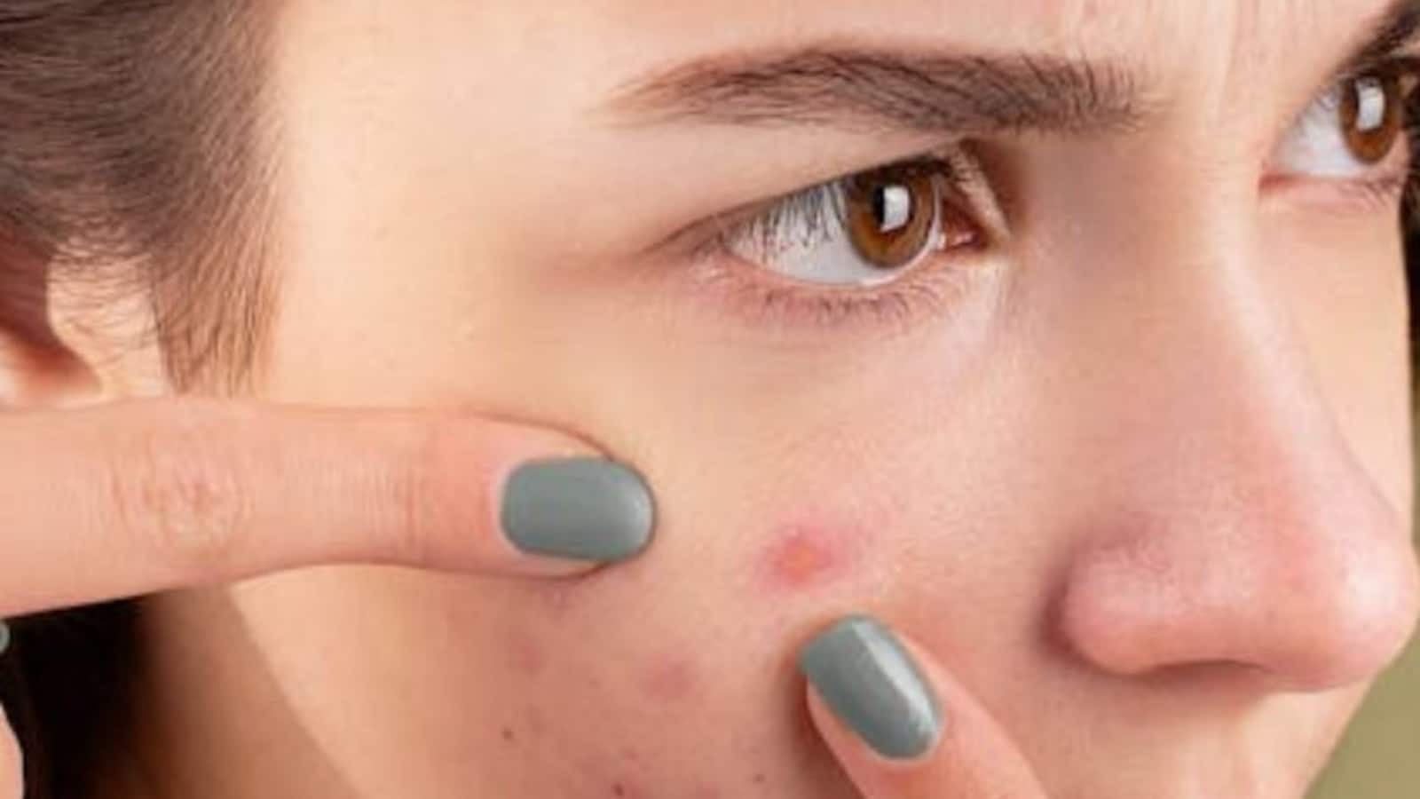 Tips For Prevent Acne During Summer