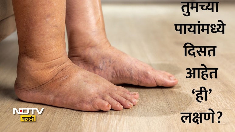 ayurvedic remedies for leg pain burning sensation and swelling tips by ...