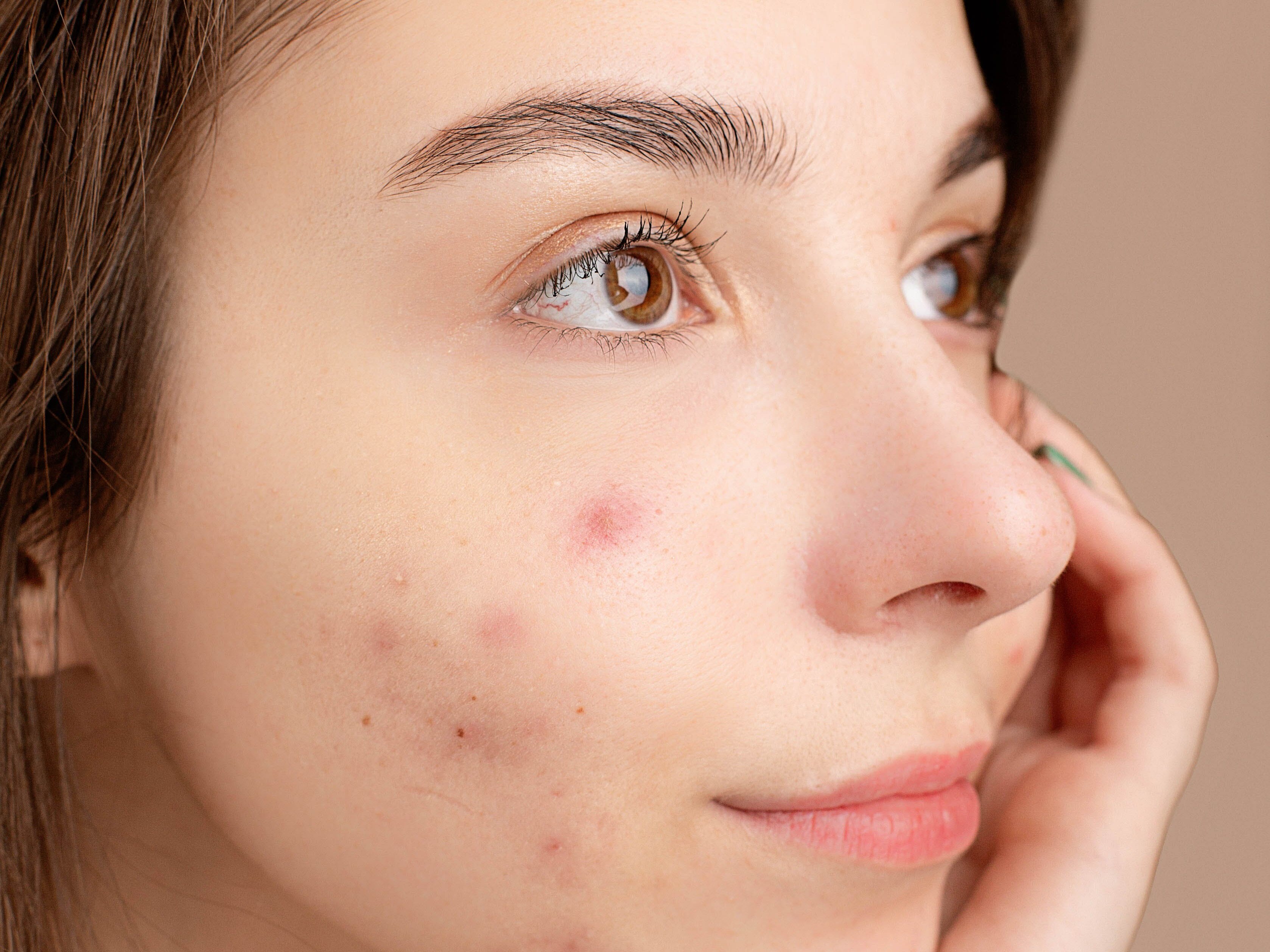 विंटर सीजन में क्या आपको भी हो जाती है पिंपल्स की समस्या, जानें इसकी वजह और ऐसे पाएं छुटकारा